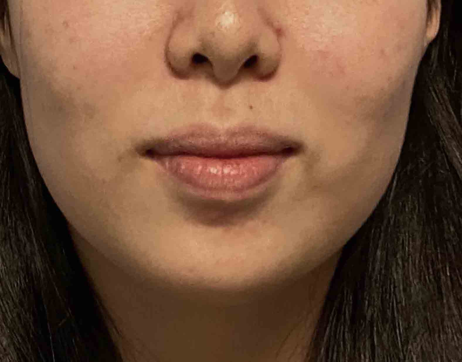 Plastic Surgery Case Study - Chin Implant Augmentation in an Asian ...