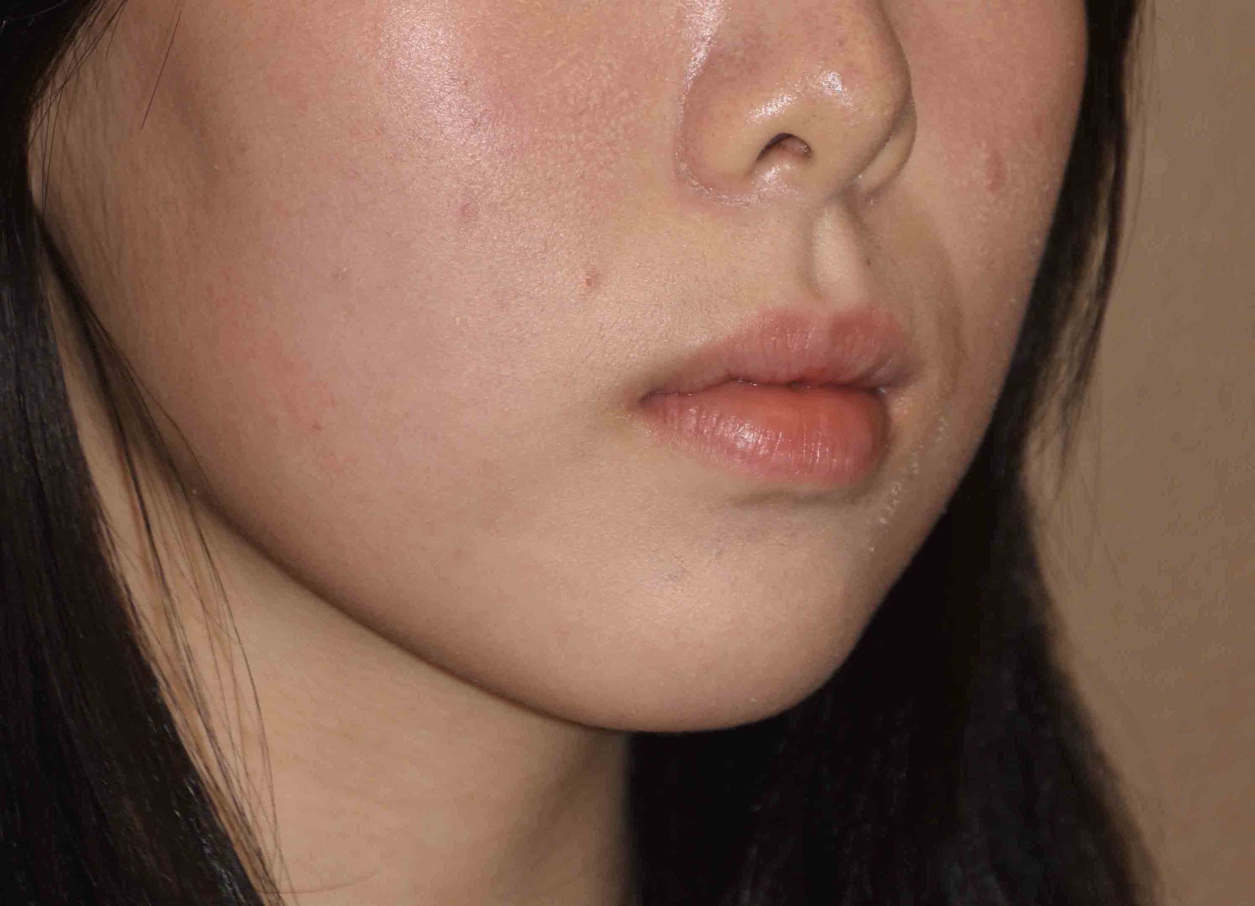 female chin implant oblique 1 Dr Barry Eppley cropped - Explore Plastic ...
