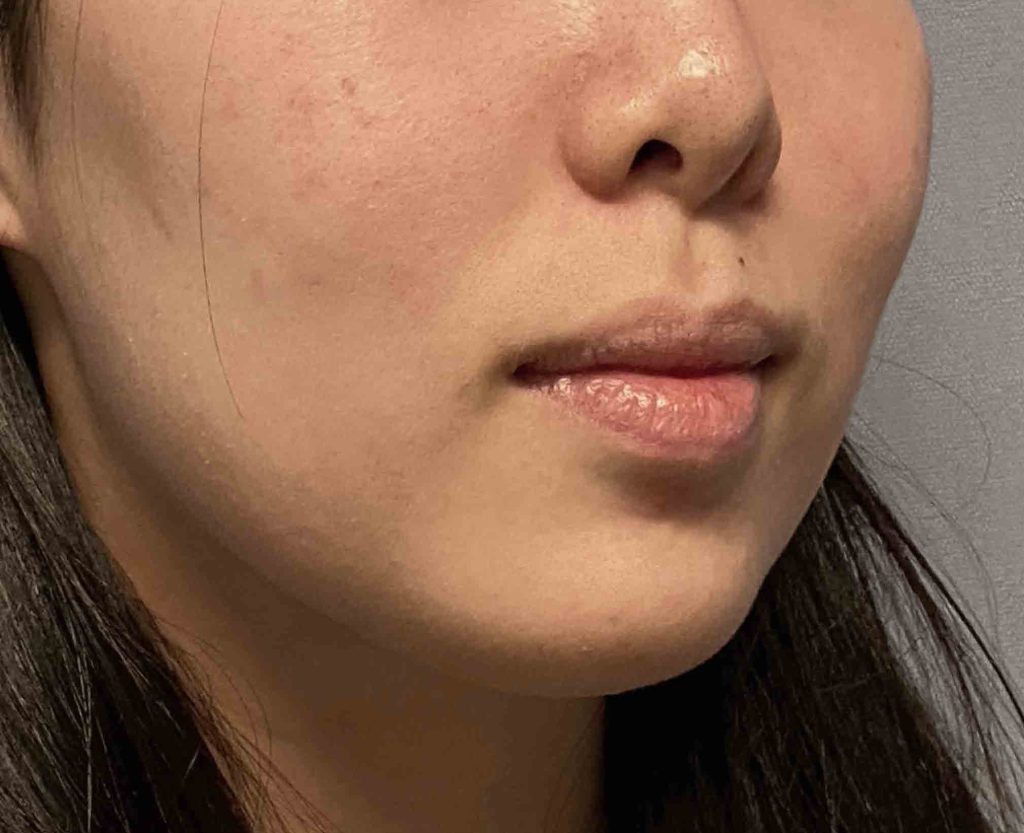 Plastic Surgery Case Study - Chin Implant Augmentation in an Asian ...
