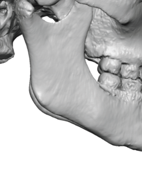 The Bony Anatomy of the Jaw Angles and Its Implications for Good ...