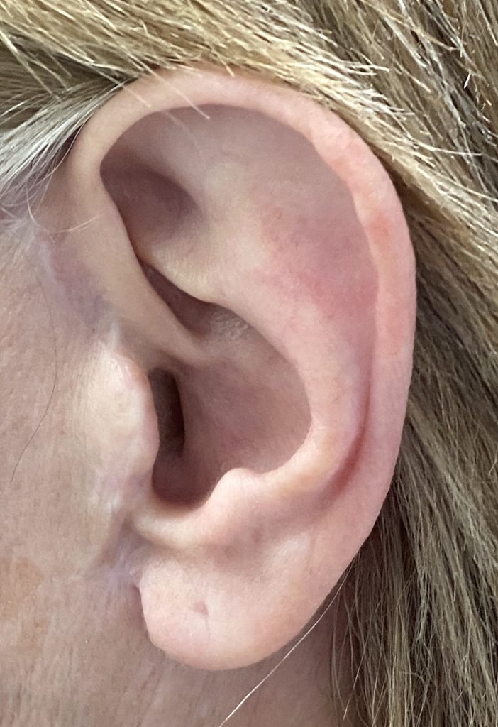 Plastic Surgery Case Study - Long-Term Results of a Central Wedge ...