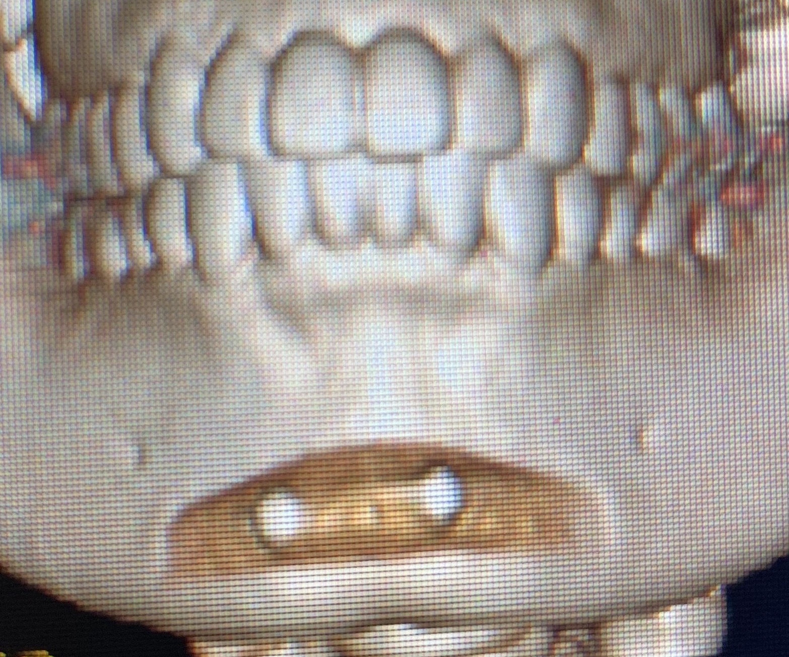 Plastic Surgery Case Study - Chin Implant Augmentation in an Asian ...