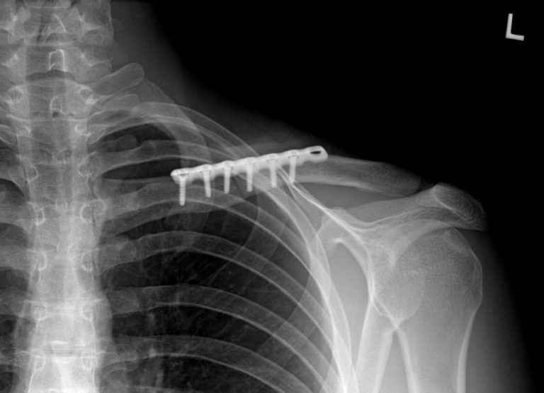 Hardware Removal After Shoulder Narrowing Surgery (Clavicle Reduction ...