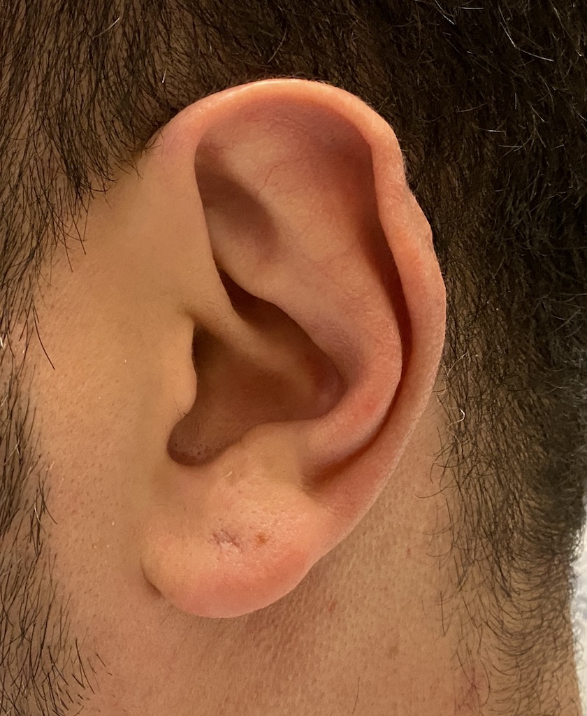 Plastic Surgery Case Study - Total Ear Reshaping with Subtotal ...