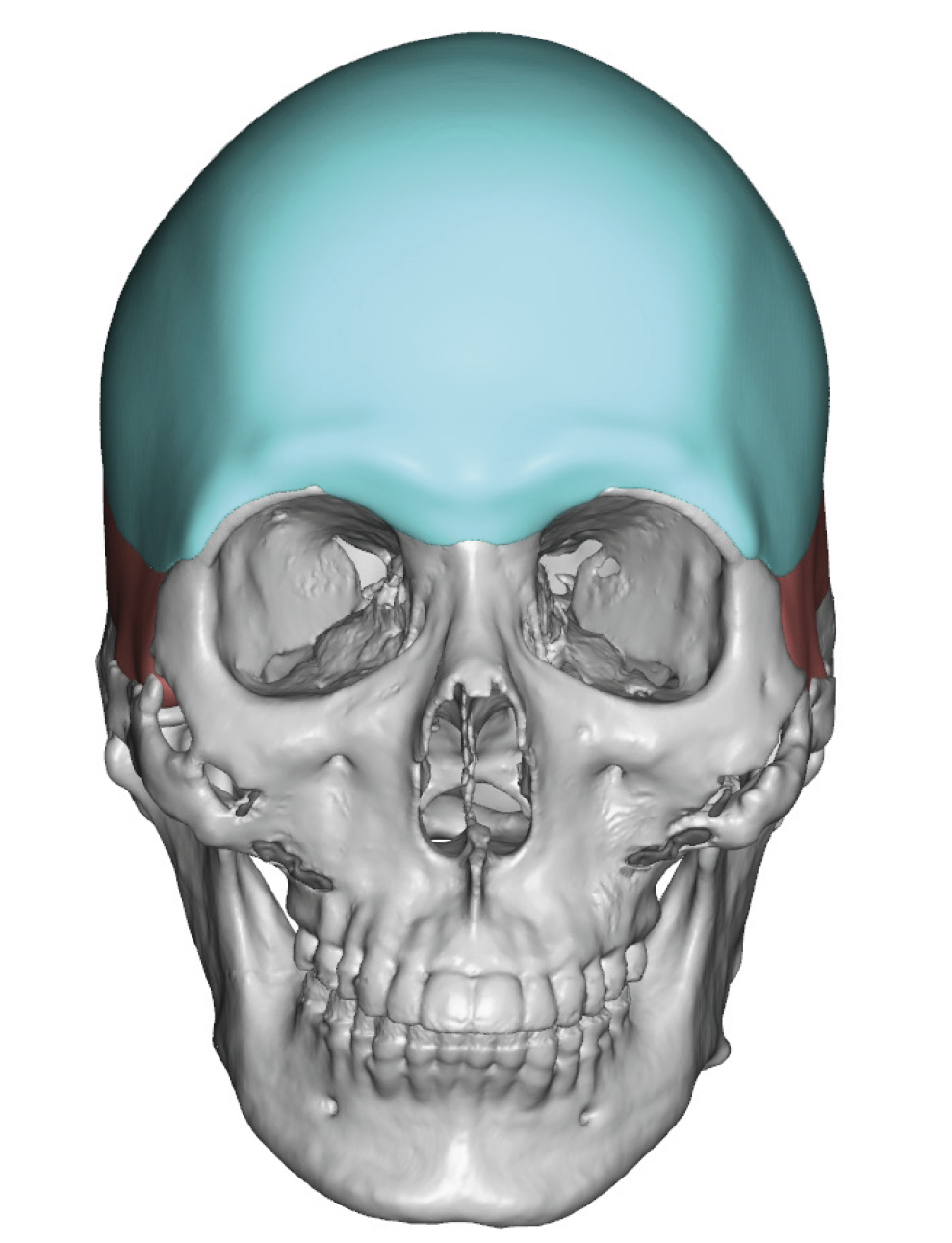 Plastic Surgery Case Study - Upper Facial Masculinization with a Custom ...