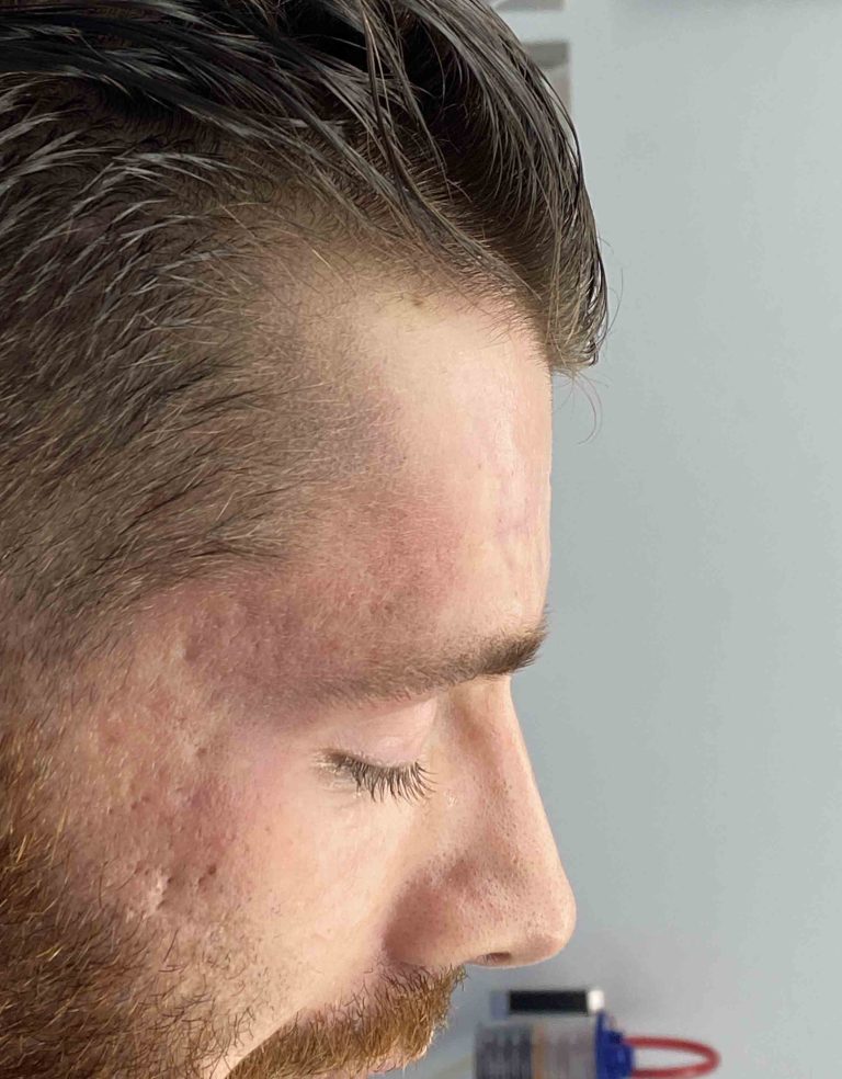 Plastic Surgery Case Study - Custom Forehead Augmentation In Male ...