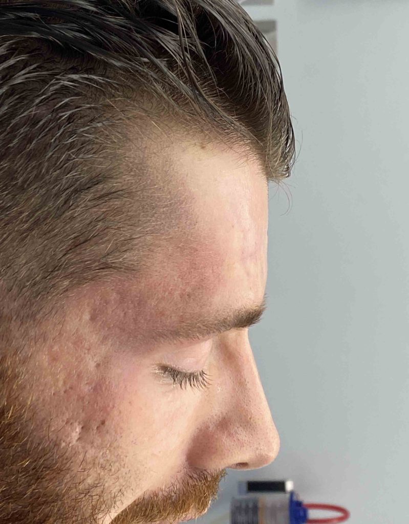 Plastic Surgery Case Study - Custom Forehead Augmentation In Male ...