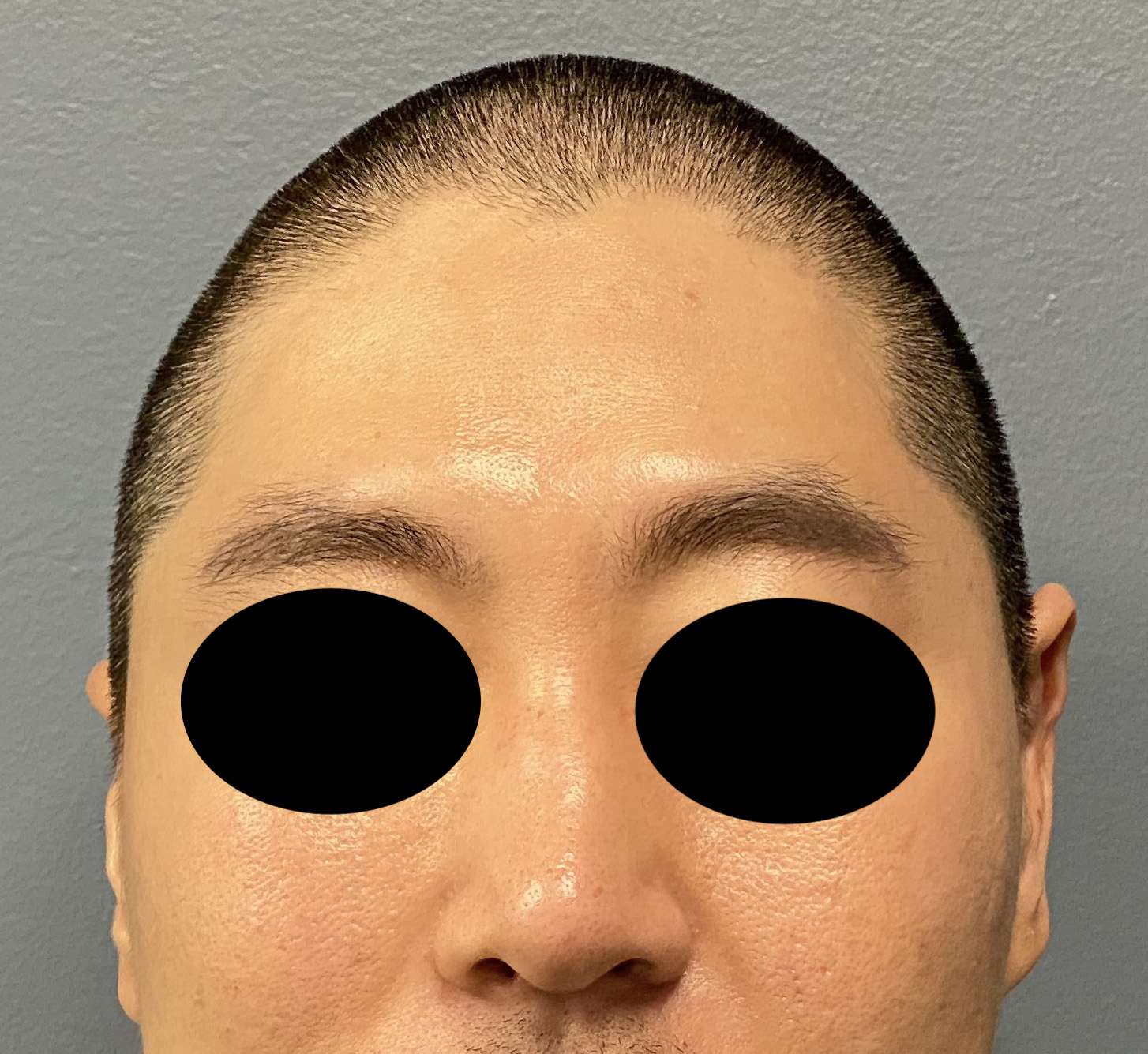 Plastic Surgery Case Study - Upper Facial Masculinization with a Custom ...