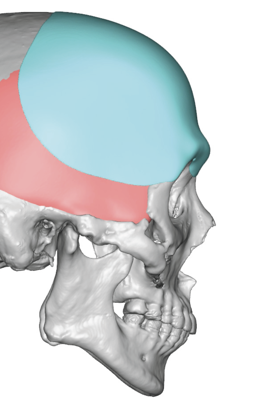 Plastic Surgery Case Study - Upper Facial Masculinization with a Custom ...