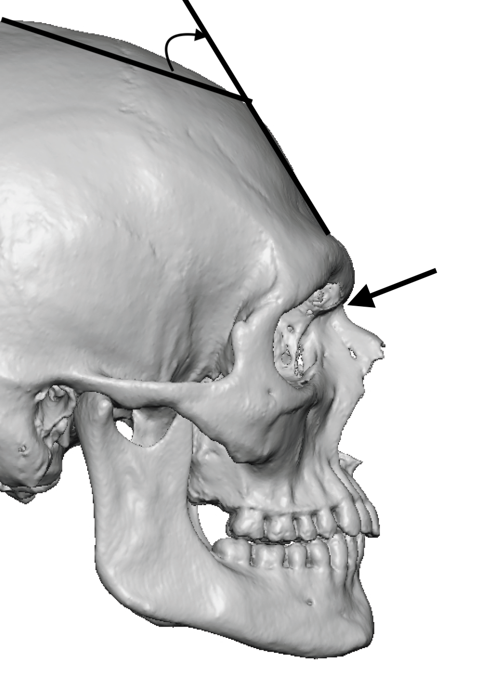 Plastic Surgery Case Study - Custom Forehead Augmentation In Male ...