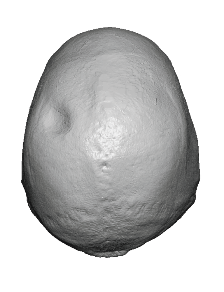 Plastic Surgery Case Study - Small Custom Skull Implant for Circular ...