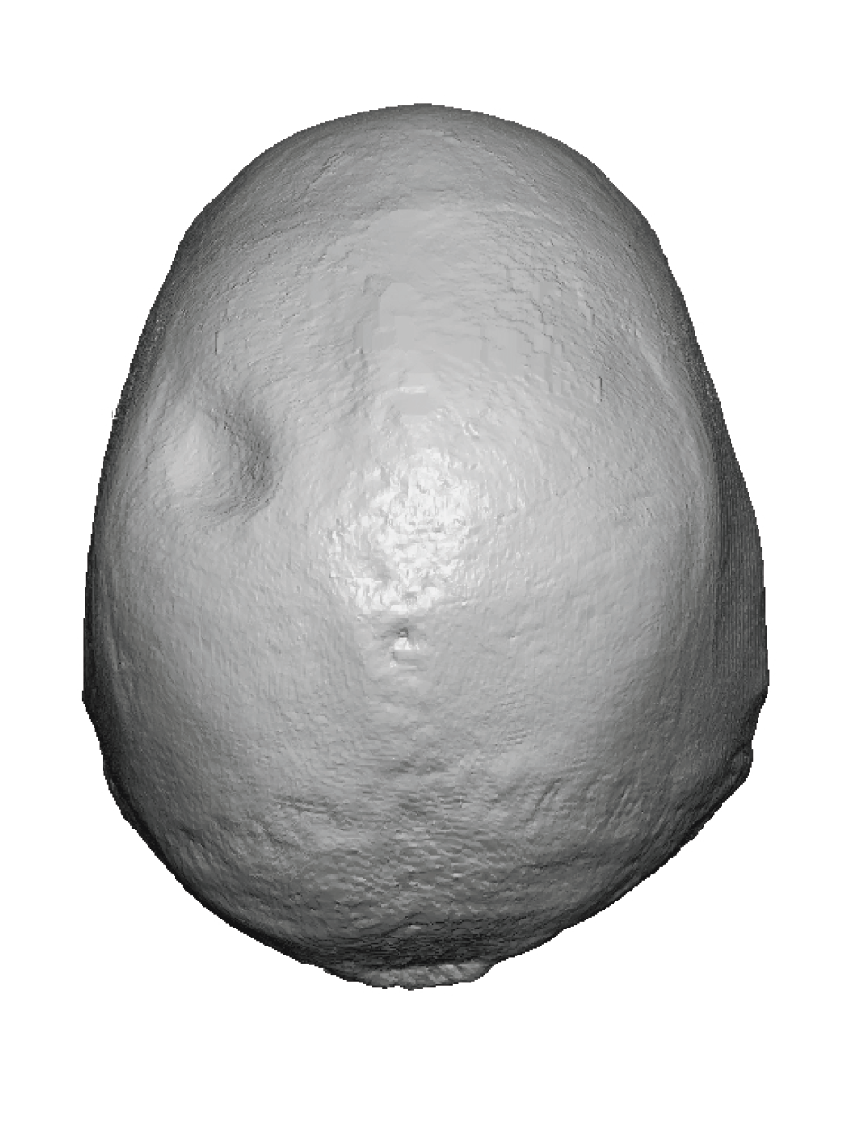 Plastic Surgery Case Study - Small Custom Skull Implant for Circular ...