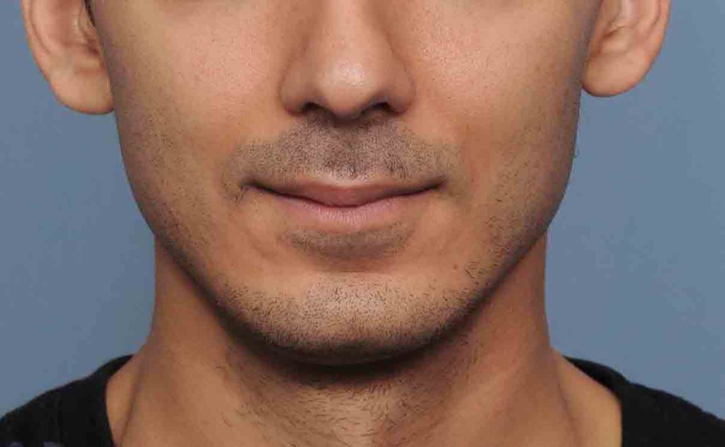 Plastic Surgery Case Study - The Combined Horizontal-Vertical Chin ...