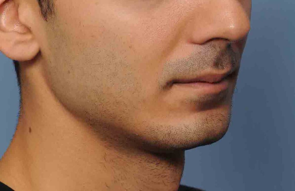 Plastic Surgery Case Study - The Combined Horizontal-Vertical Chin ...