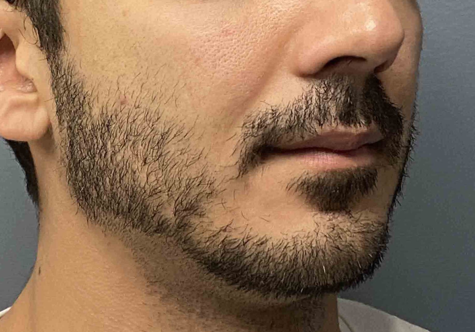 Plastic Surgery Case Study - The Combined Horizontal-Vertical Chin ...