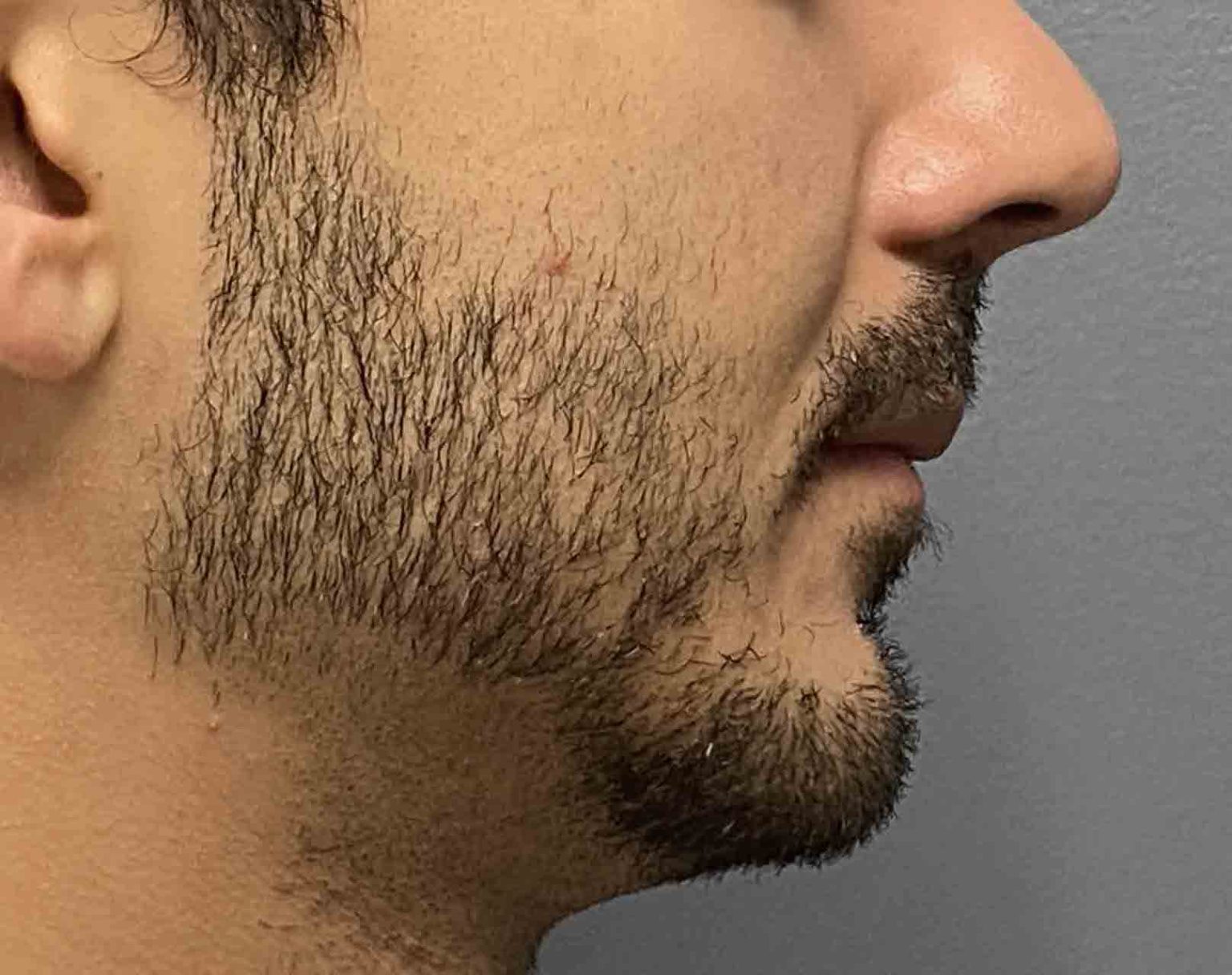 Plastic Surgery Case Study - The Combined Horizontal-Vertical Chin ...