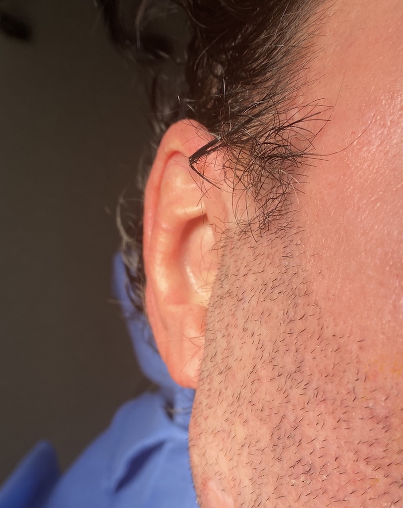 Technical Strategies - Cartilage Grafting in Subtotal Otoplasty ...