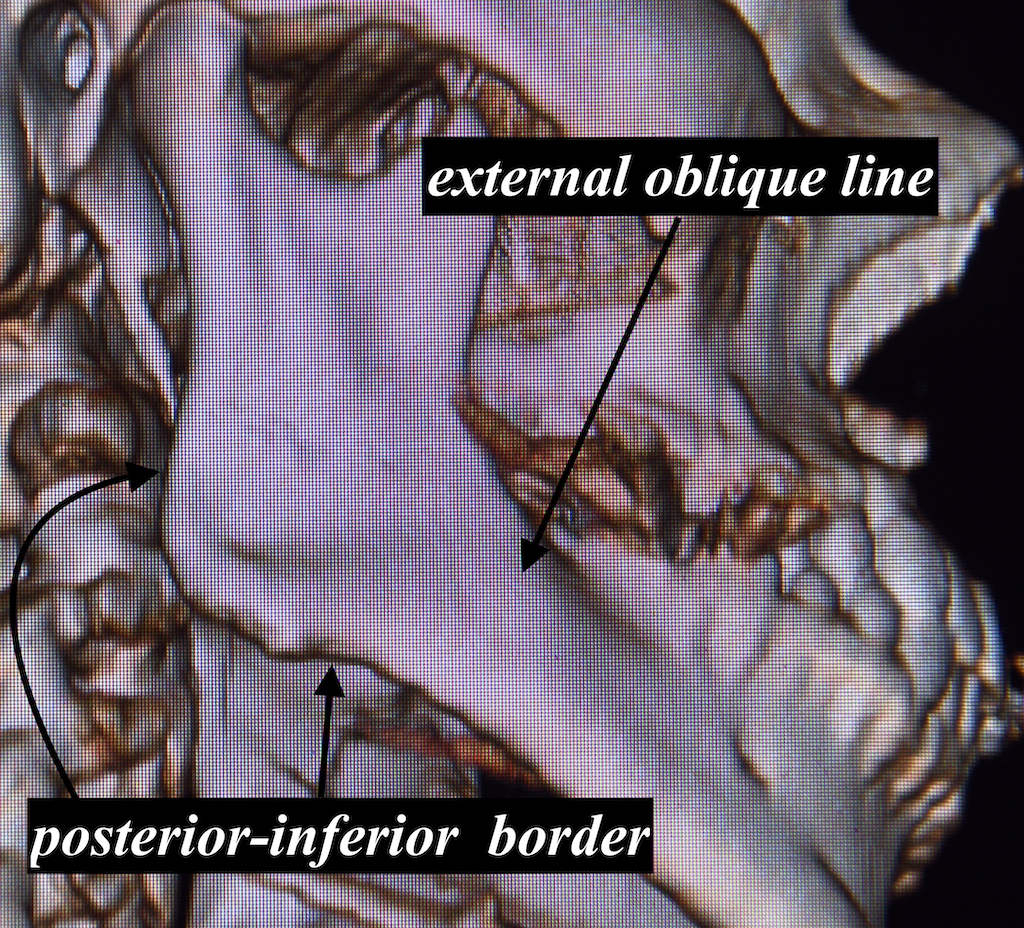 The Bony Anatomy of the Jaw Angles and Its Implications for Good ...
