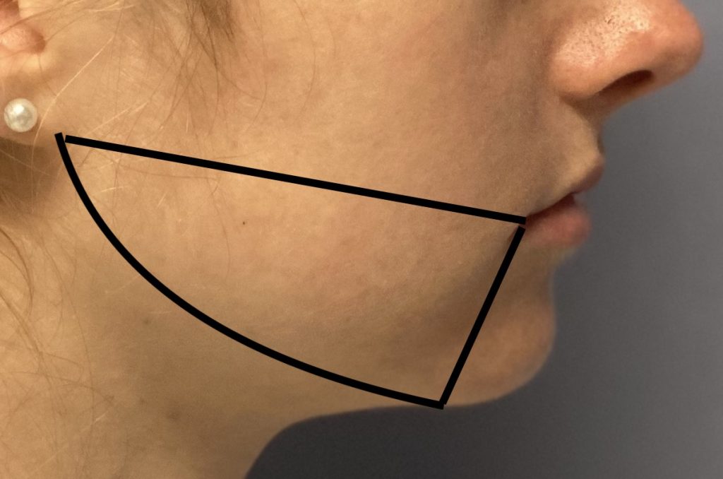 The Safety and Effectiveness of Perioral Liposuction - Explore Plastic ...