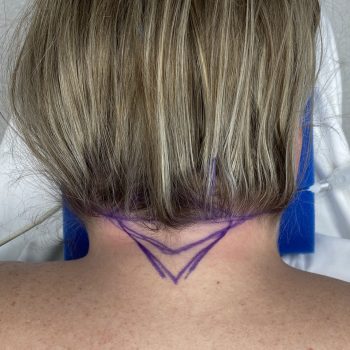 webbed neck surgery Archives - Explore Plastic Surgery