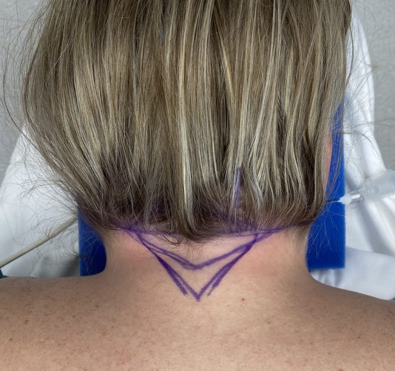 Plastic Surgery Case Study - Webbed Neck Correction Using A Posterior ...