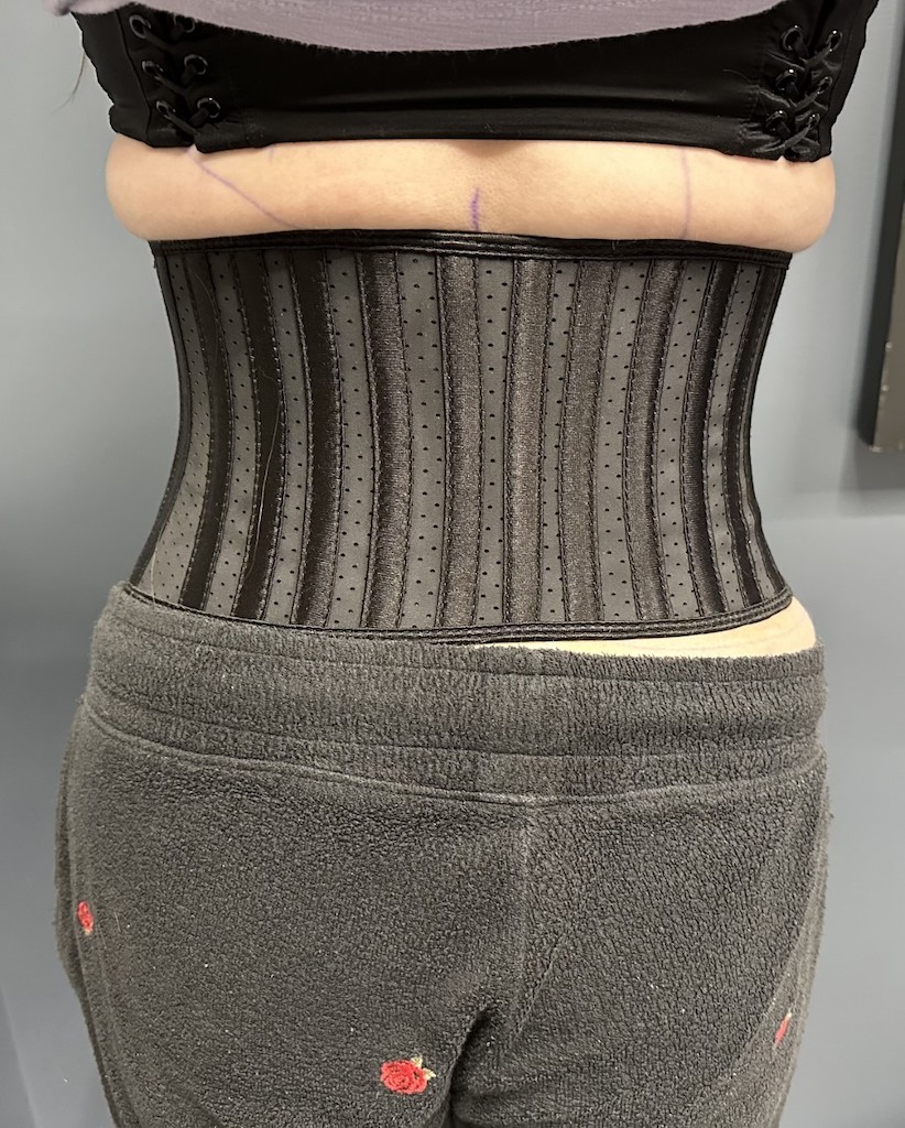 Corseting Garments After Rib Removal Surgery - Explore Plastic Surgery