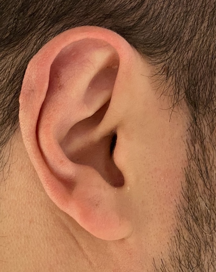 Plastic Surgery Case Study - Total Ear Reshaping with Subtotal ...