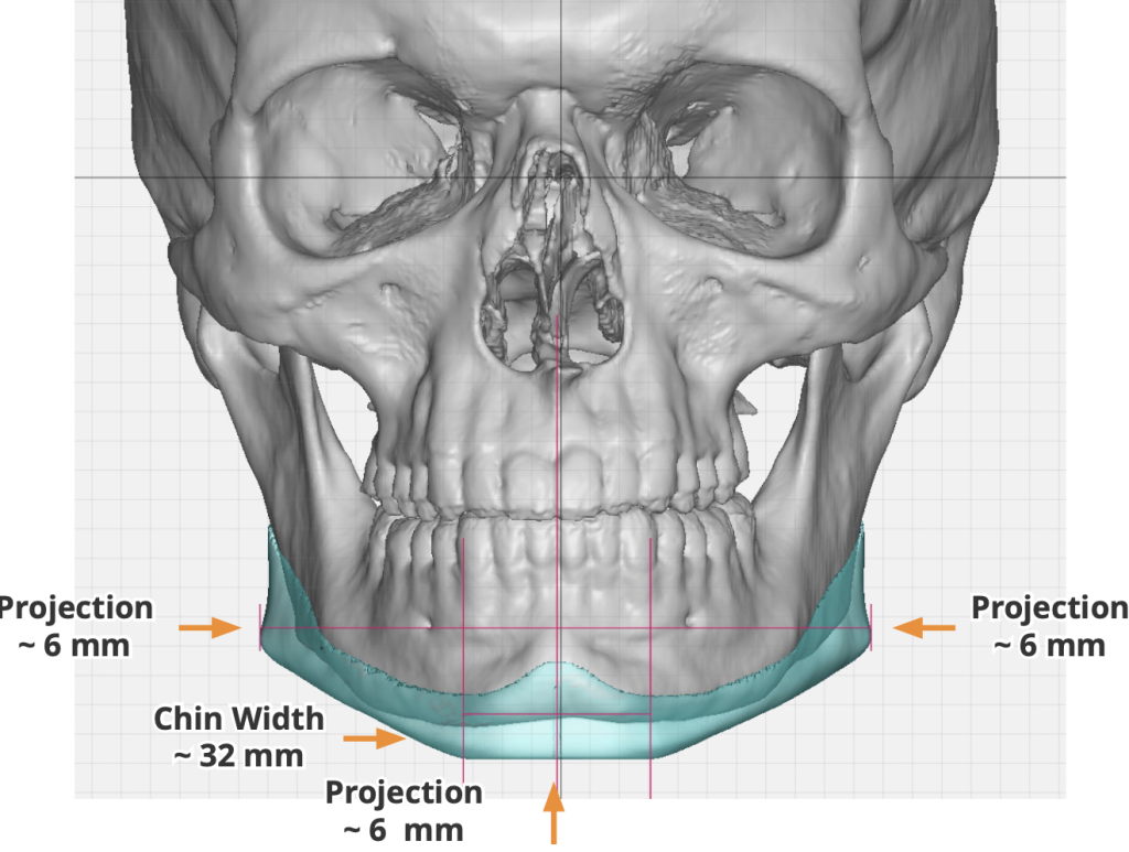 Plastic Surgery Case Study - The Vertical Lengthening Custom Jawline ...