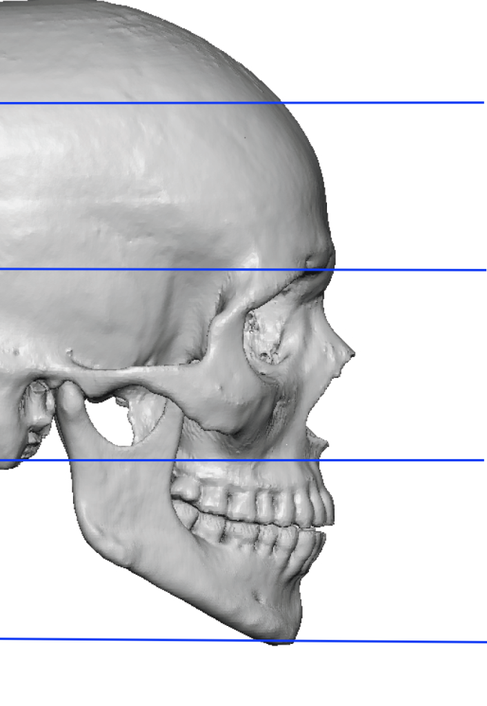 Plastic Surgery Case Study - Vertical Jawline Lengthening with Opening ...