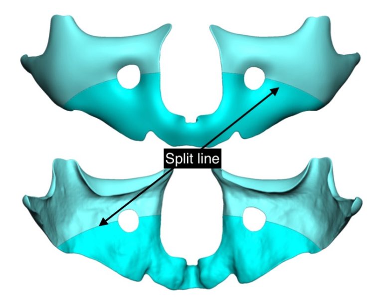 Plastic Surgery Case Study - Achieving A Non-Osteotomy Midface ...