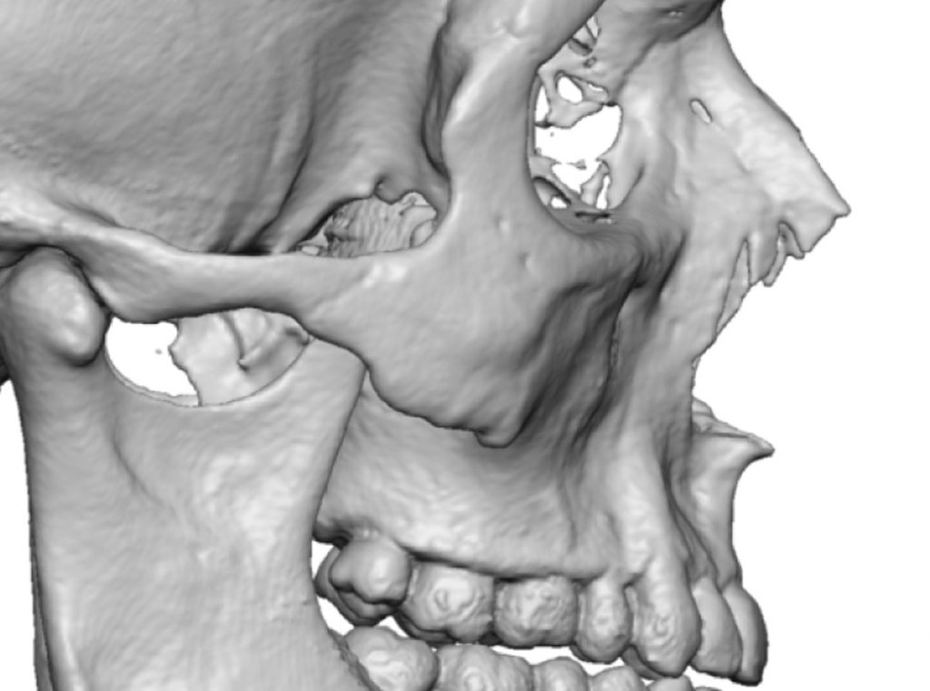 Plastic Surgery Case Study - Achieving A Non-Osteotomy Midface ...