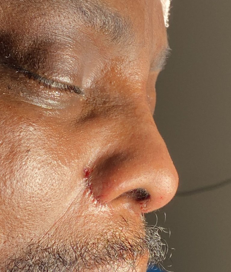 Plastic Surgery Case Study - Bridge Augmentation and Nostril Flaring ...