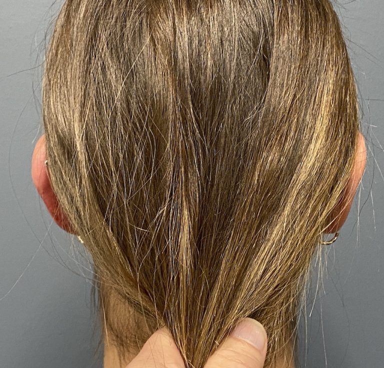 Plastic Surgery Case Study - Long-Term Suture Extrusion in Setback ...