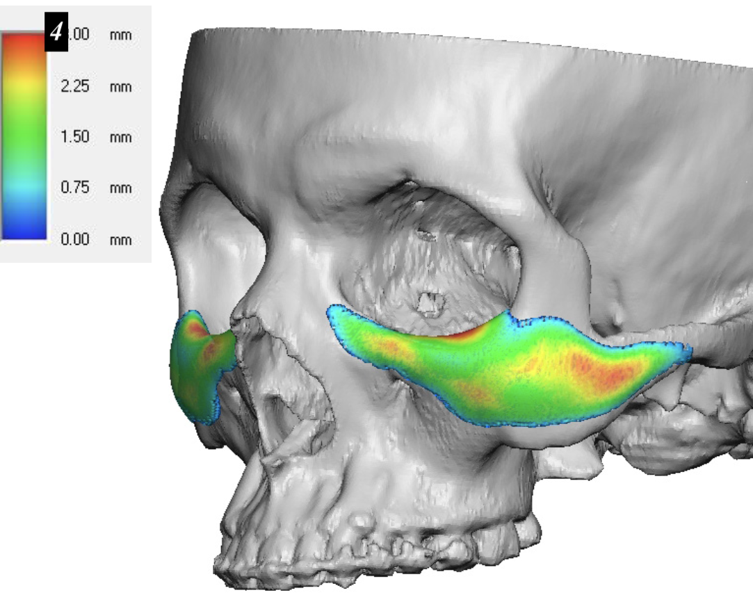 Plastic Surgery Case Study - Intraoperative Modification of Custom Infraorbital-Malar Implants ...