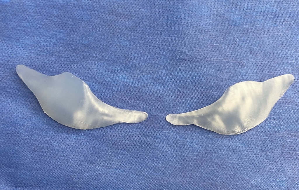 Technical Strategies - The Lower Eyelid Incisional Placement of Custom ...