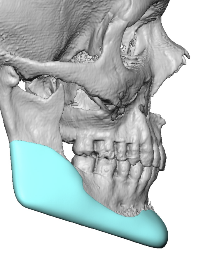 Plastic Surgery Case Study - Custom Jawline Implant for 3D Vertical ...