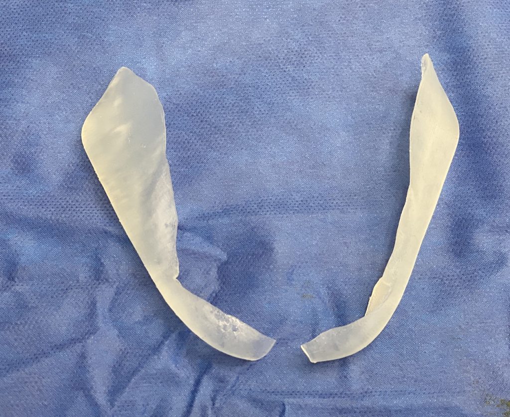 Plastic Surgery Case Study - A Combined Autologous - Alloplastic Method ...