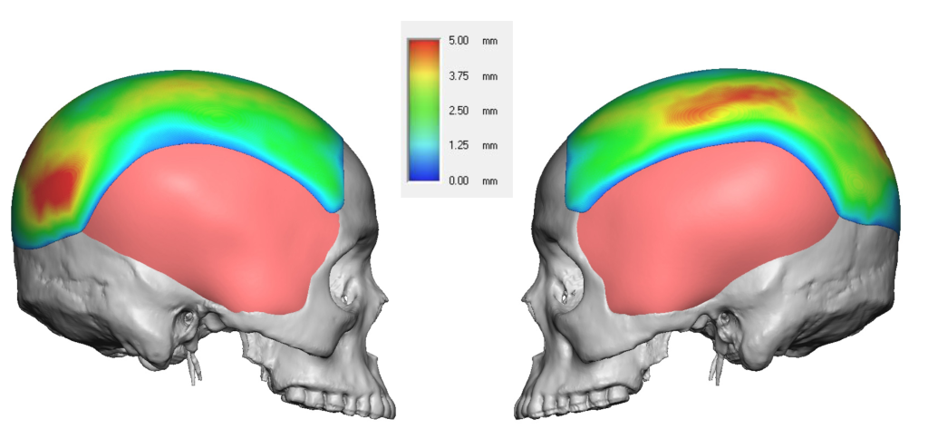 Plastic Surgery Case Study - Custom Skull Implant for Reshaping the ...