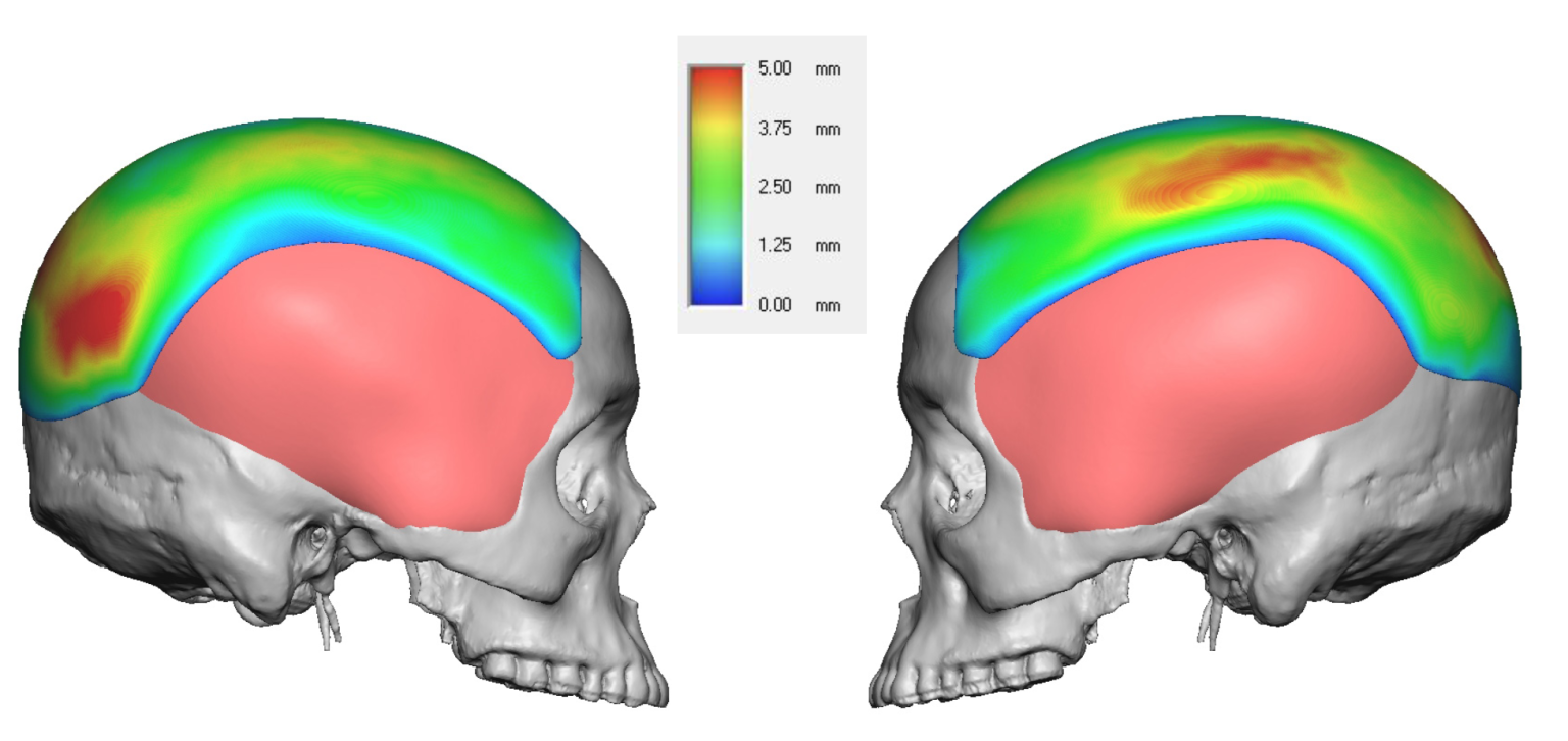 Plastic Surgery Case Study - Custom Skull Implant for Reshaping the ...