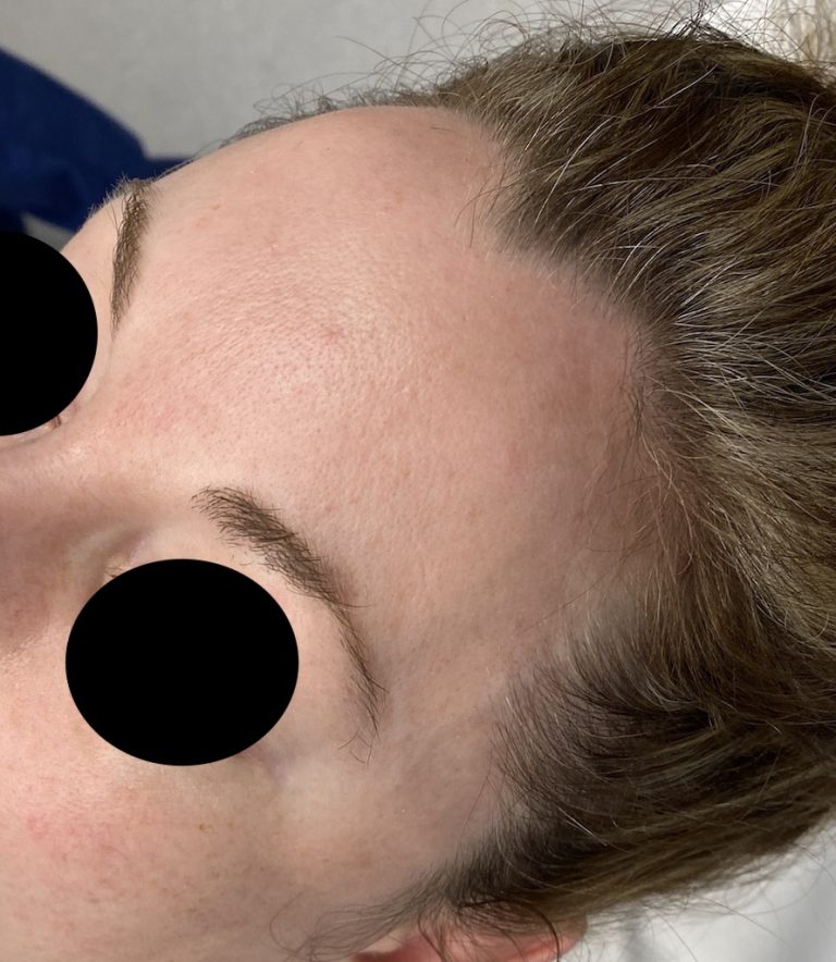 Plastic Surgery Case Study - Temporal Implant Replacements for Reduced ...