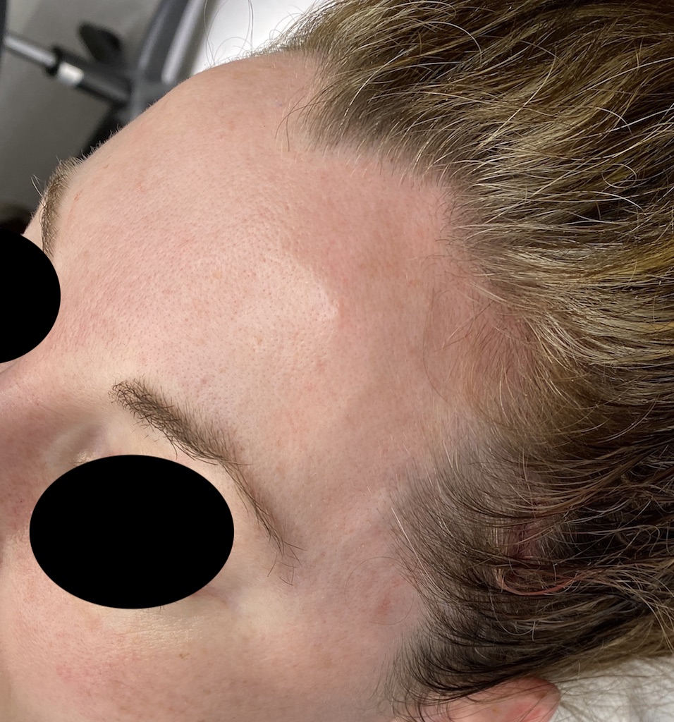 Plastic Surgery Case Study - Temporal Implant Replacements for Reduced ...