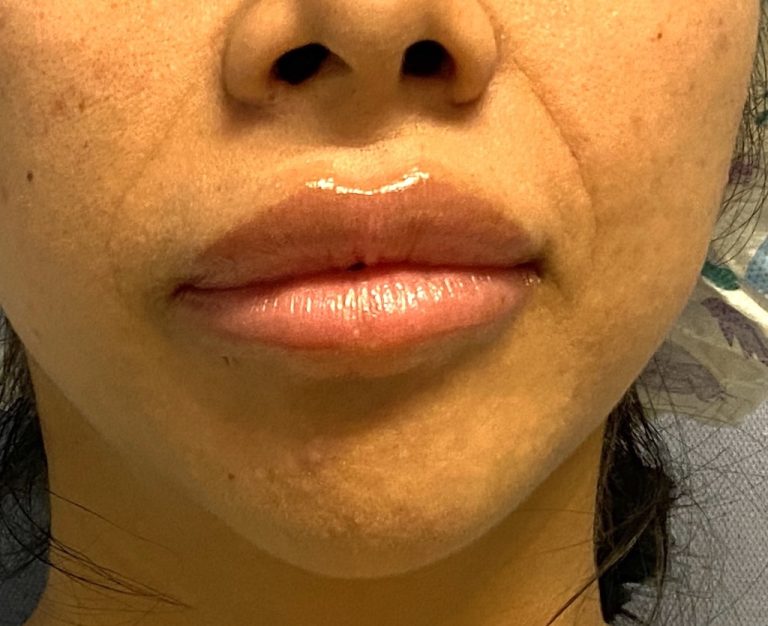 Plastic Surgery Case Study - The Submental Technique for the Treatment ...