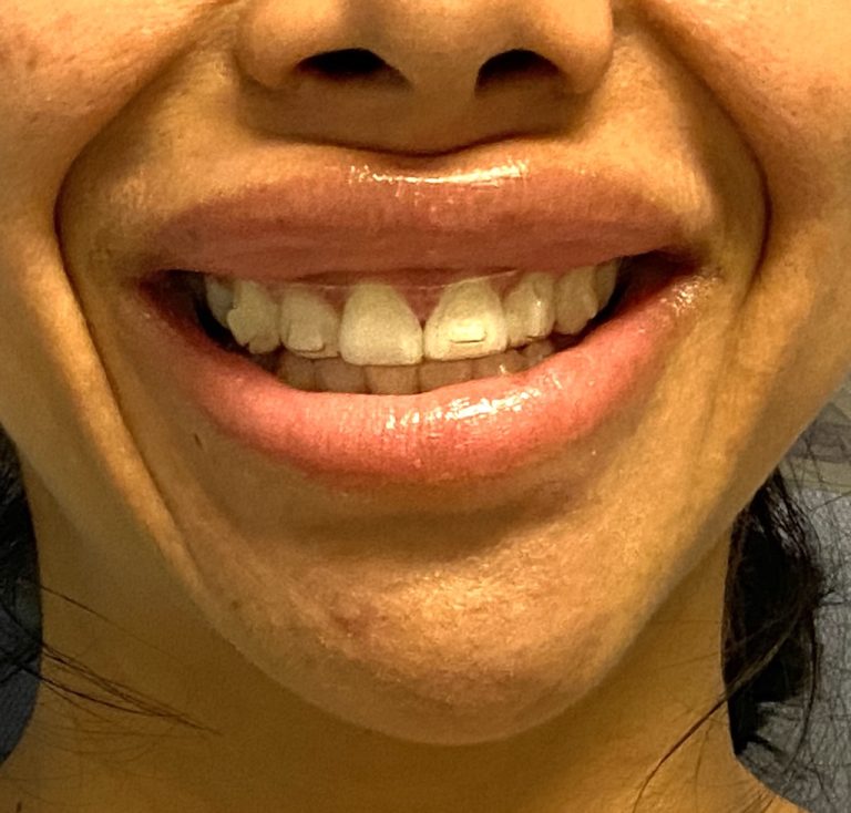 Plastic Surgery Case Study - The Submental Technique for the Treatment ...