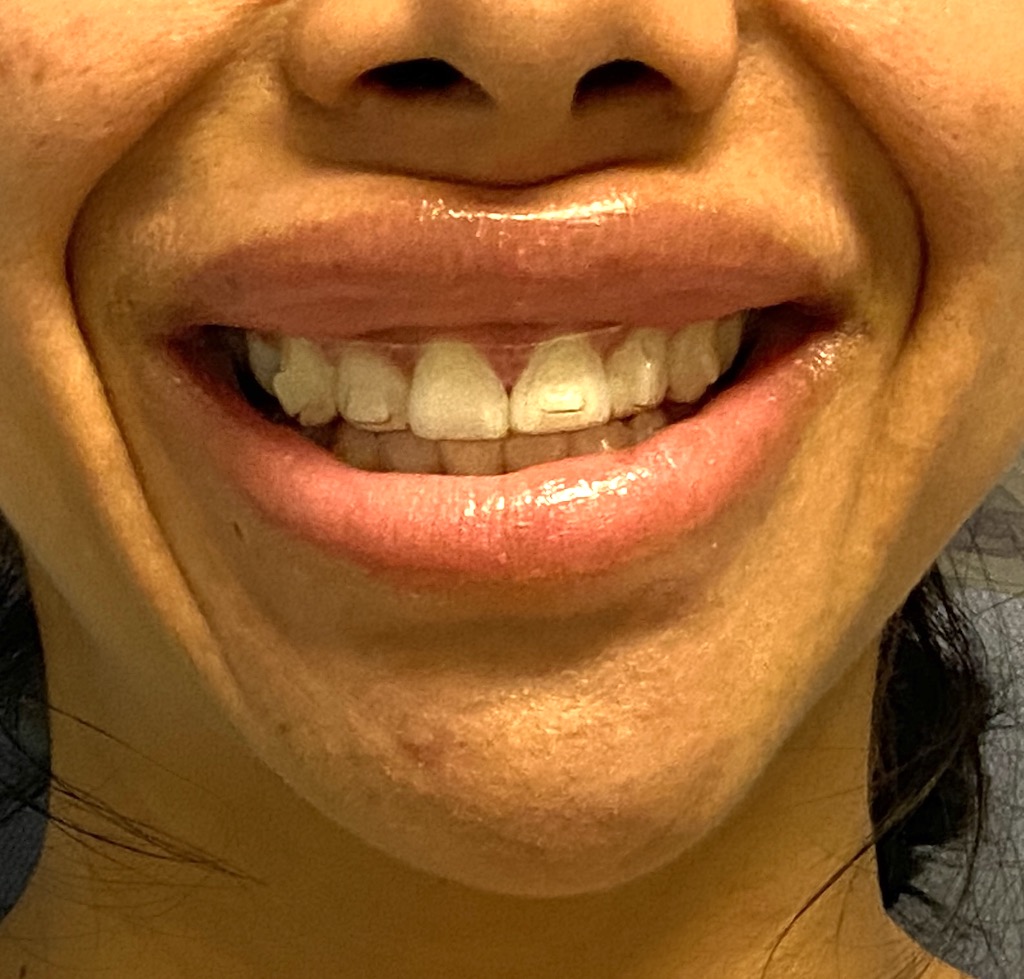 Plastic Surgery Case Study - The Submental Technique for the Treatment ...