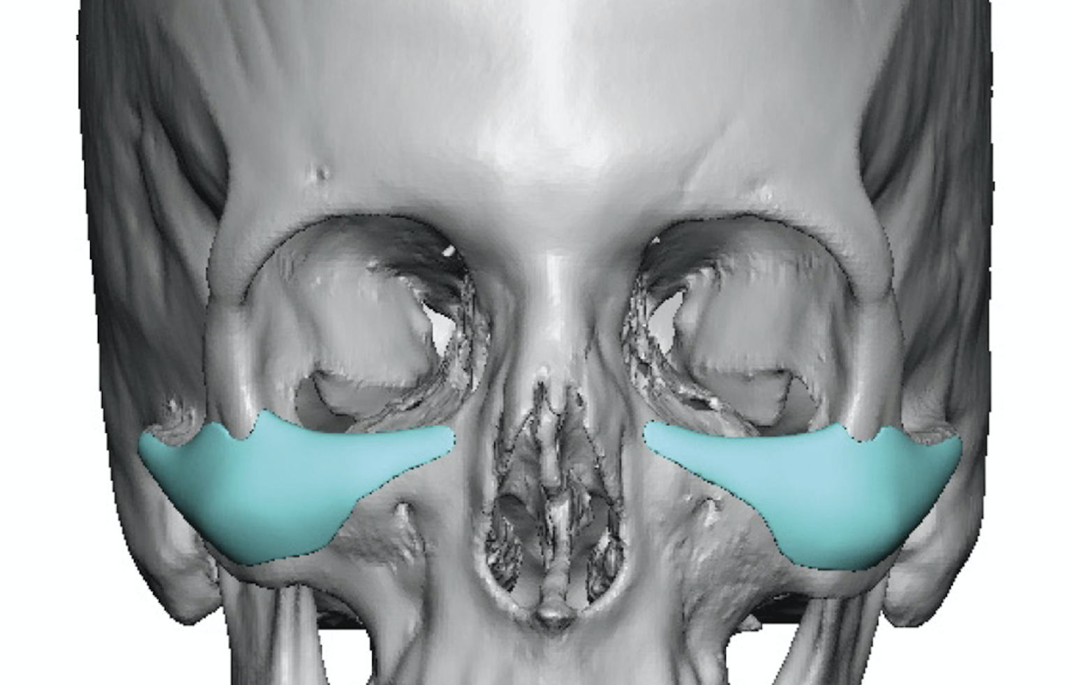 The Relationship Between Lower Eyelid Shape and The Underlying ...