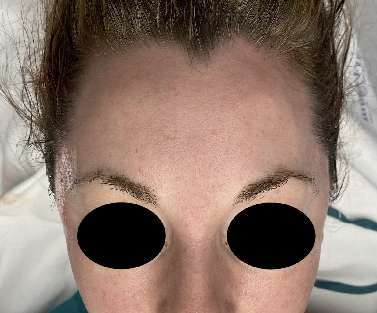 female custom temporal implant replacements result front view Dr Barry ...