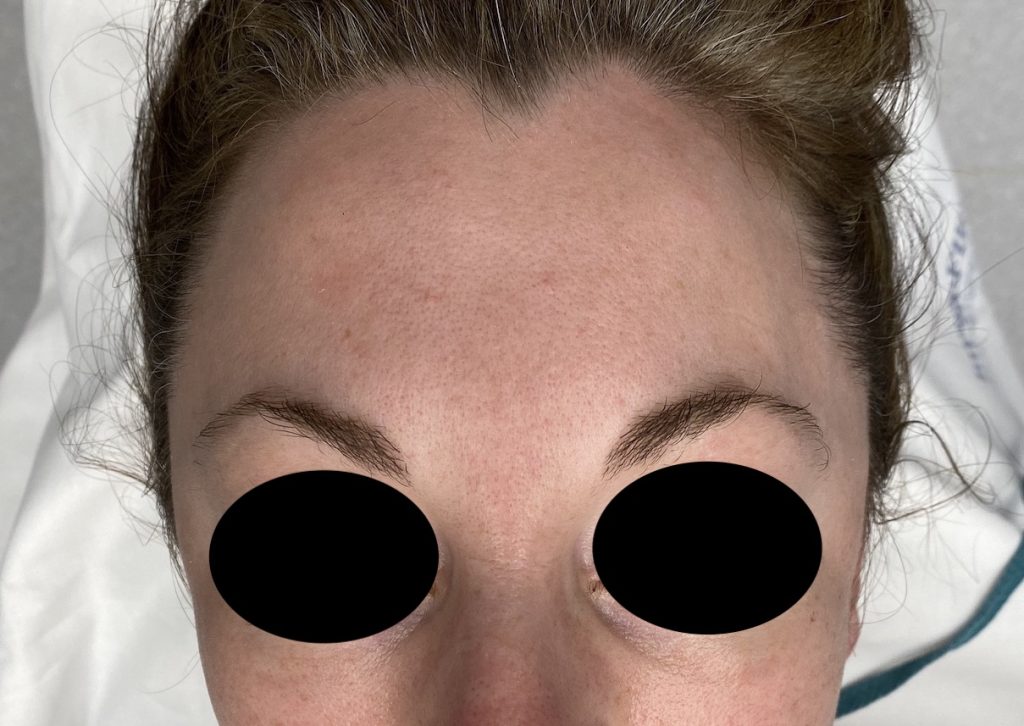 Plastic Surgery Case Study - Temporal Implant Replacements for Reduced ...