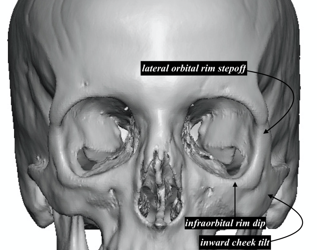 The Relationship Between Lower Eyelid Shape and The Underlying ...