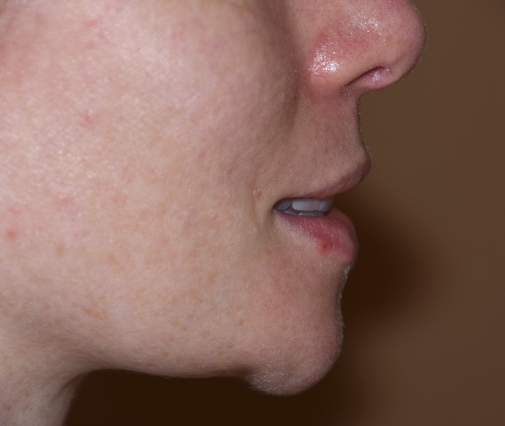 Plastic Surgery Case Study - Stage 2 Chin Ptosis Correction with ...