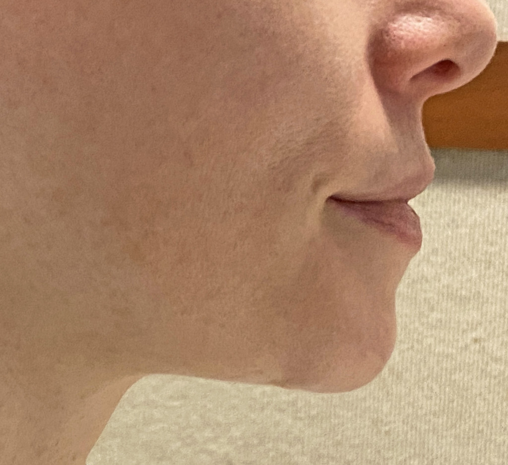 Plastic Surgery Case Study - Stage 2 Chin Ptosis Correction with ...